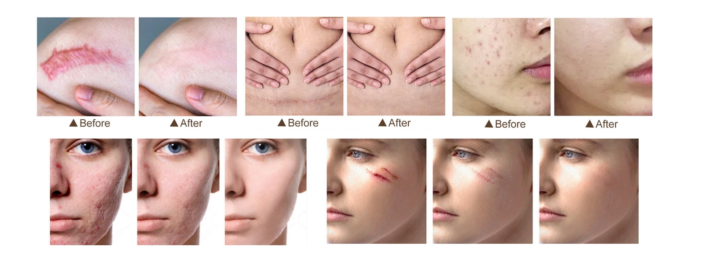 How CO2 Laser Treatment Works for Scar Reduction and Skin Renewal - MQLASER
